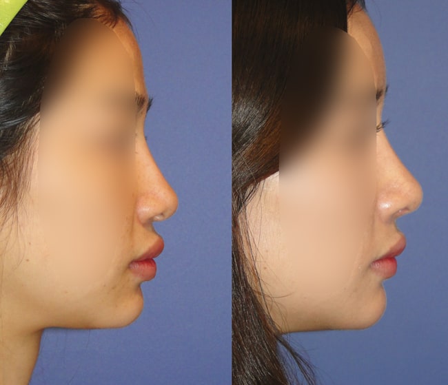 Revision Rhinoplasty for Deviated Nose with Rib Cartilage | VIP