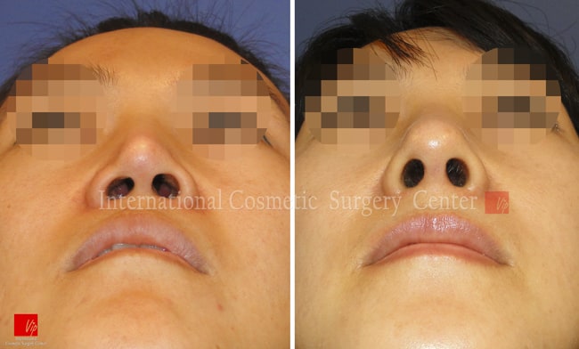 Revision Rhinoplasty with Rib Cartilage for Deviated Nose | VIP
