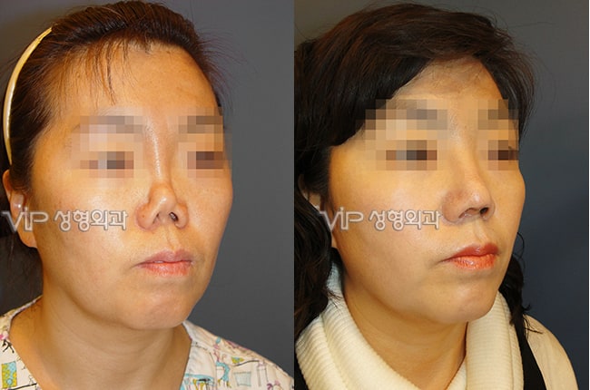 Revision rhinoplasty with Rib cartilage Collapsed by silicone implant