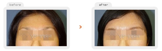 Fat graft – forehead & temple Case 2 | VIP Plastic Surgery Korea