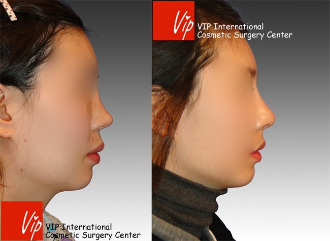 Silicone nose revision - Rib cartilage rhinoplasty | VIP