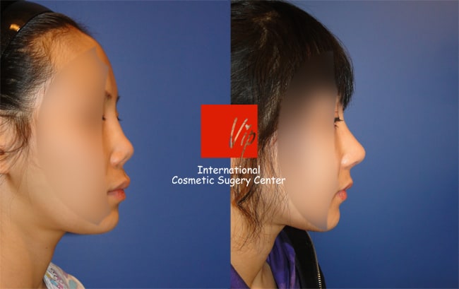 Silicone Implant Nose Revision with Rib Cartilage | VIP Plastic Surgery ...