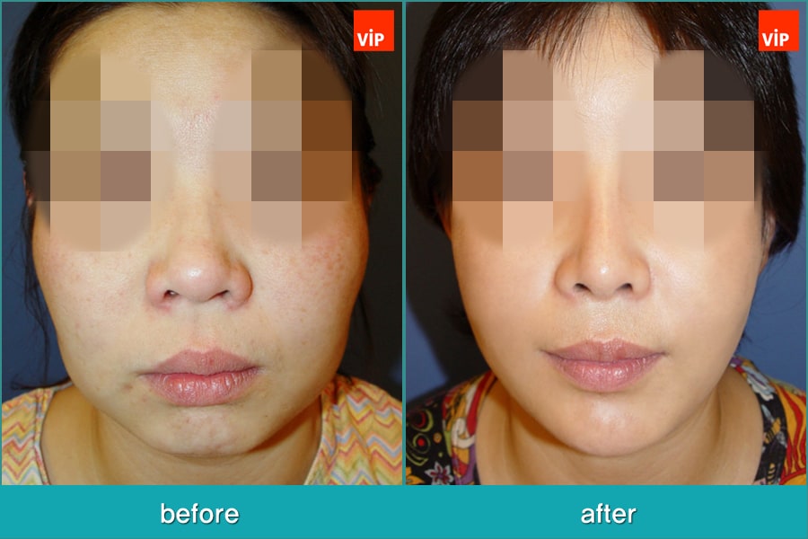 Rib Cartilage Rhinoplasty, Face Contouring, V-line, Facial Surgery