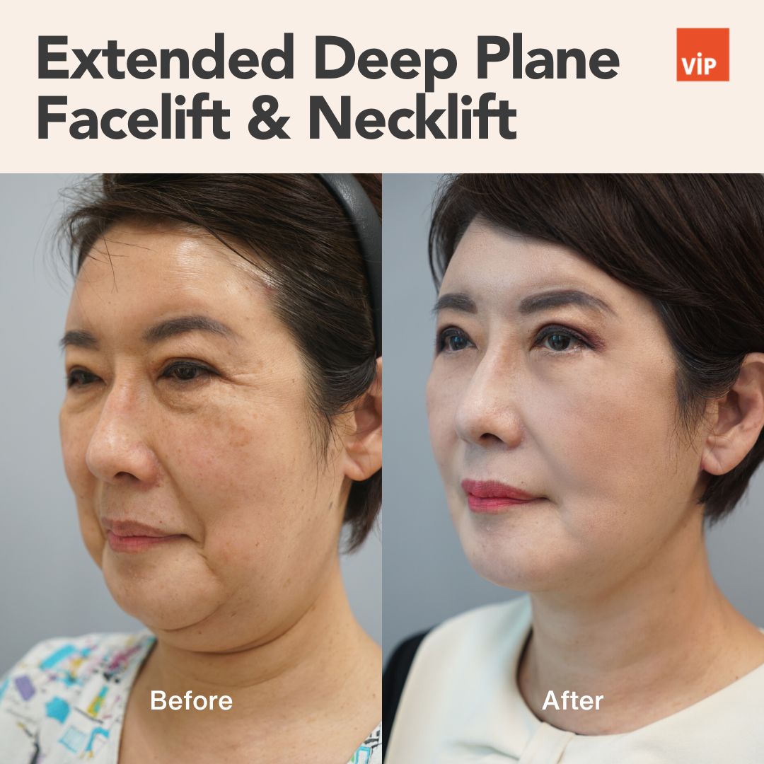 Before & After: Deep Plane Facelift with Neck Rejuvenation