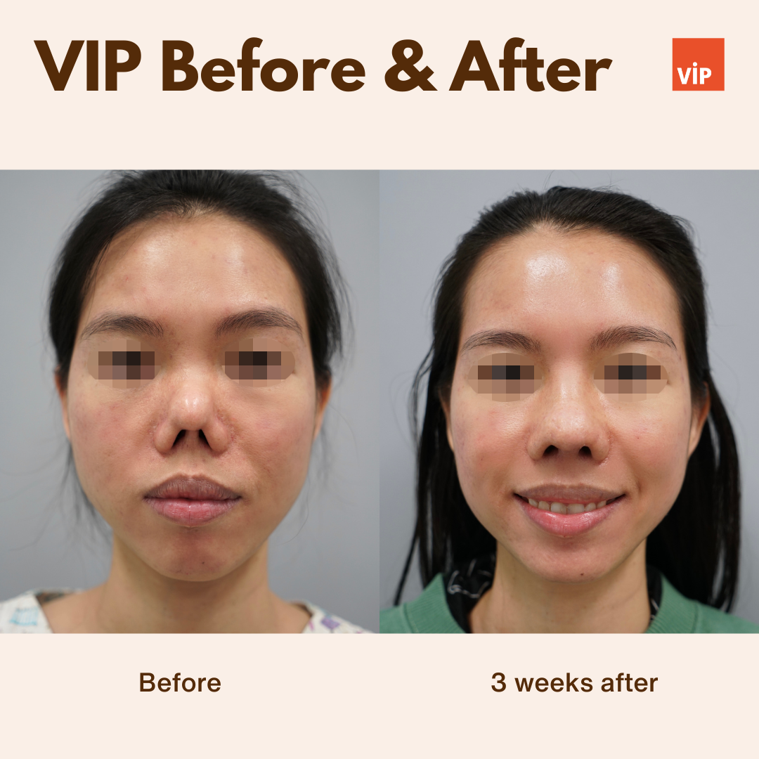 Revision Rhinoplasty Before & After Photos | Rib Cartilage Structural ...