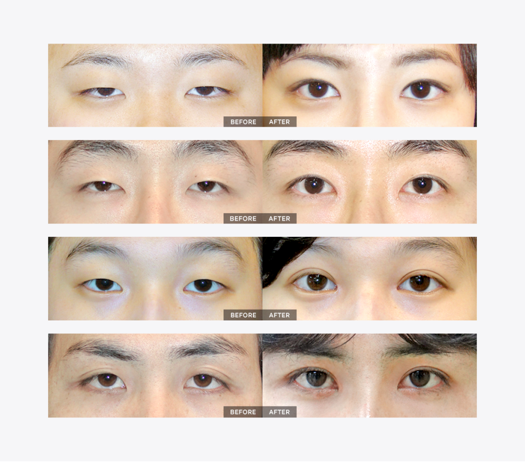 Ptosis Correction Surgery in Korea | VIP Plastic Surgery