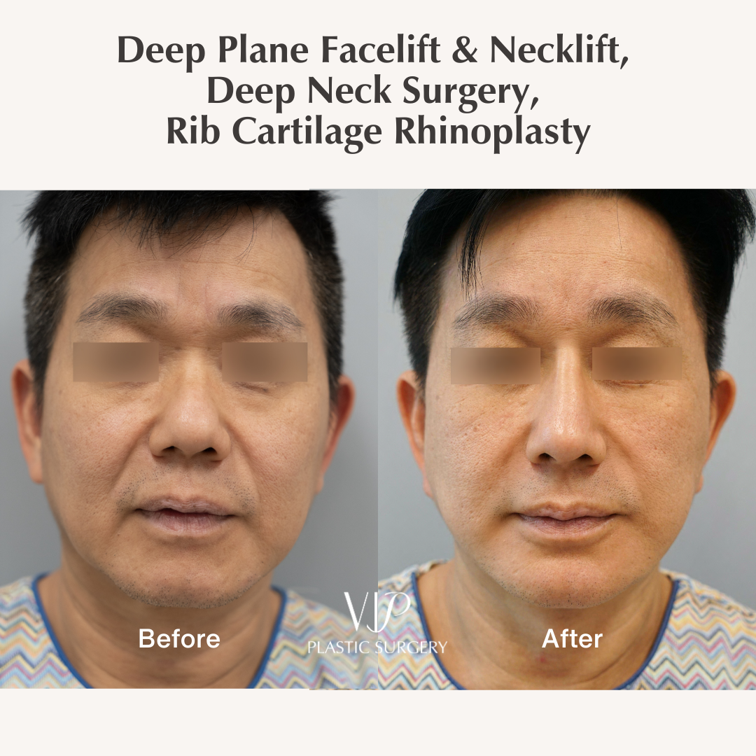 Deep Plane Facelift, Necklift, Rib Cartilage Rhinoplasty Before & After